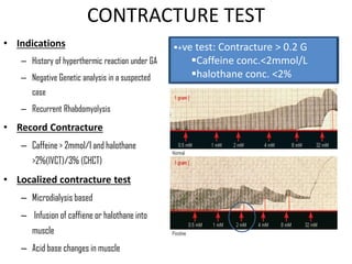 Malignant hyperthermia [final] | PPTX