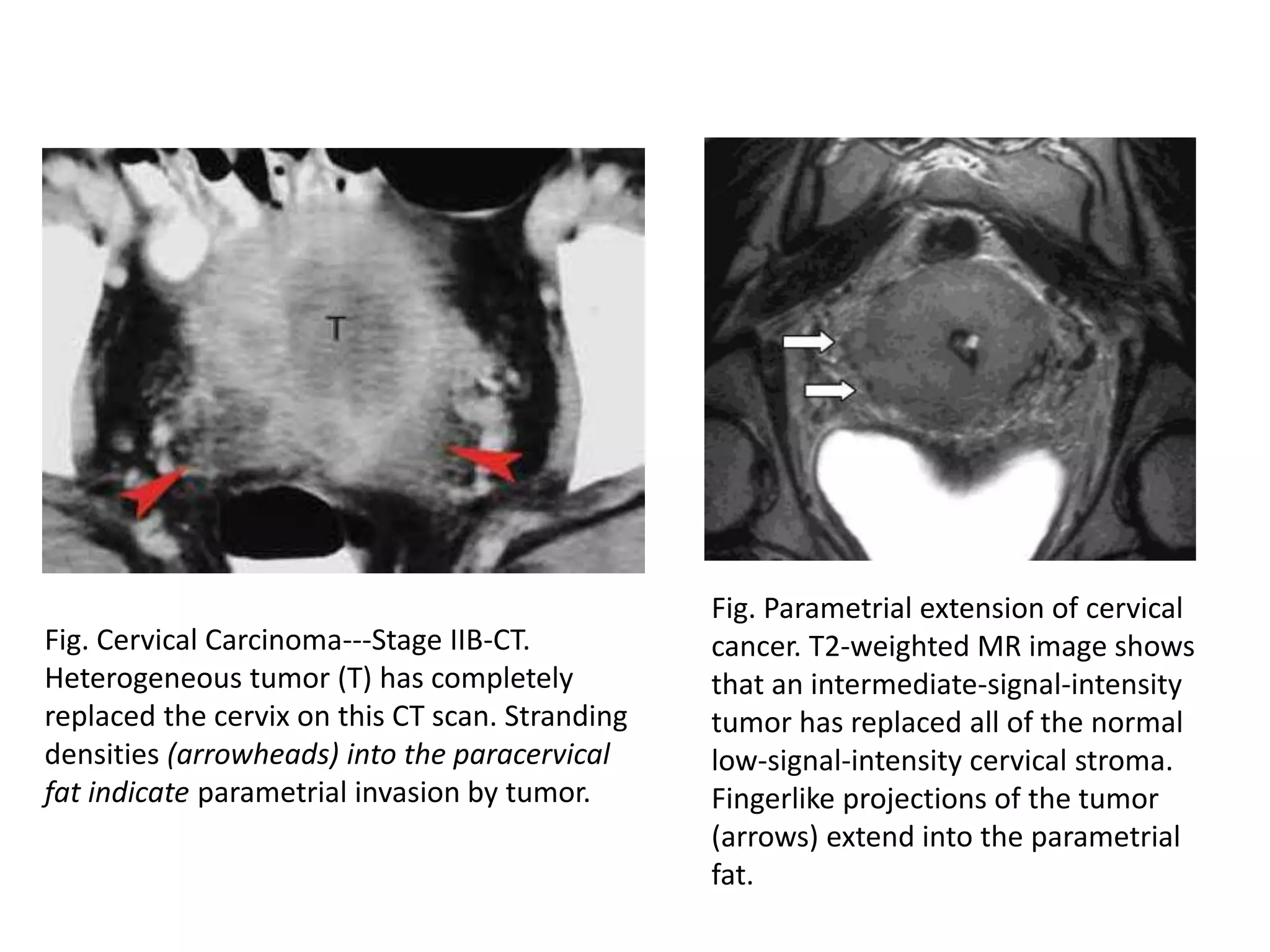 Malignant lesions of uterus | PPTX