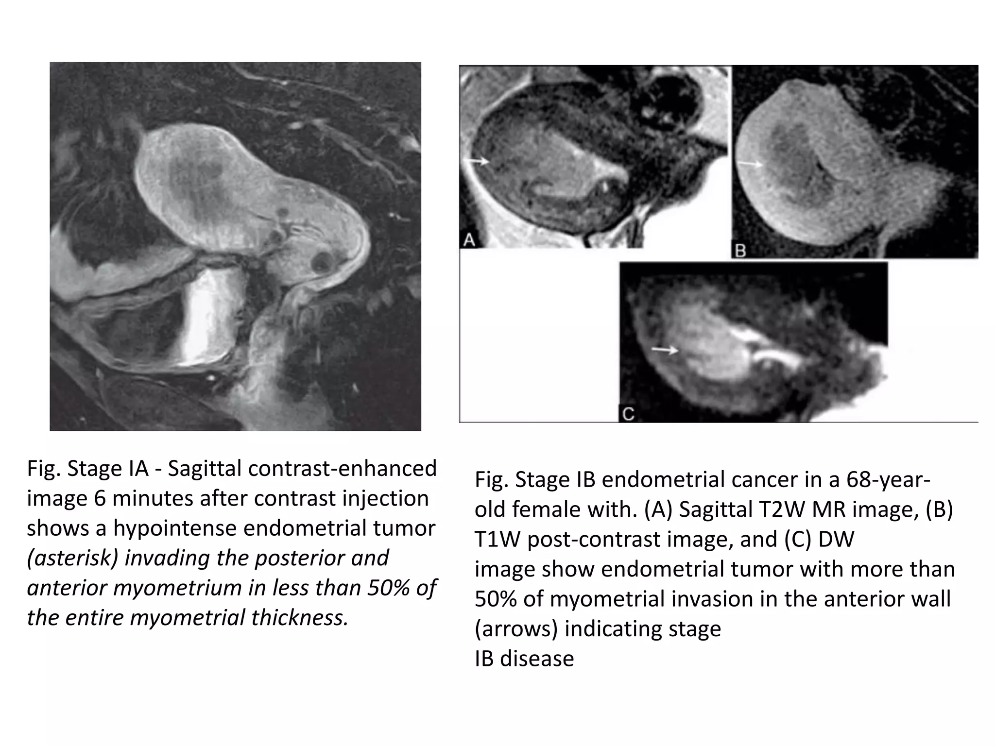 Malignant lesions of uterus | PPTX