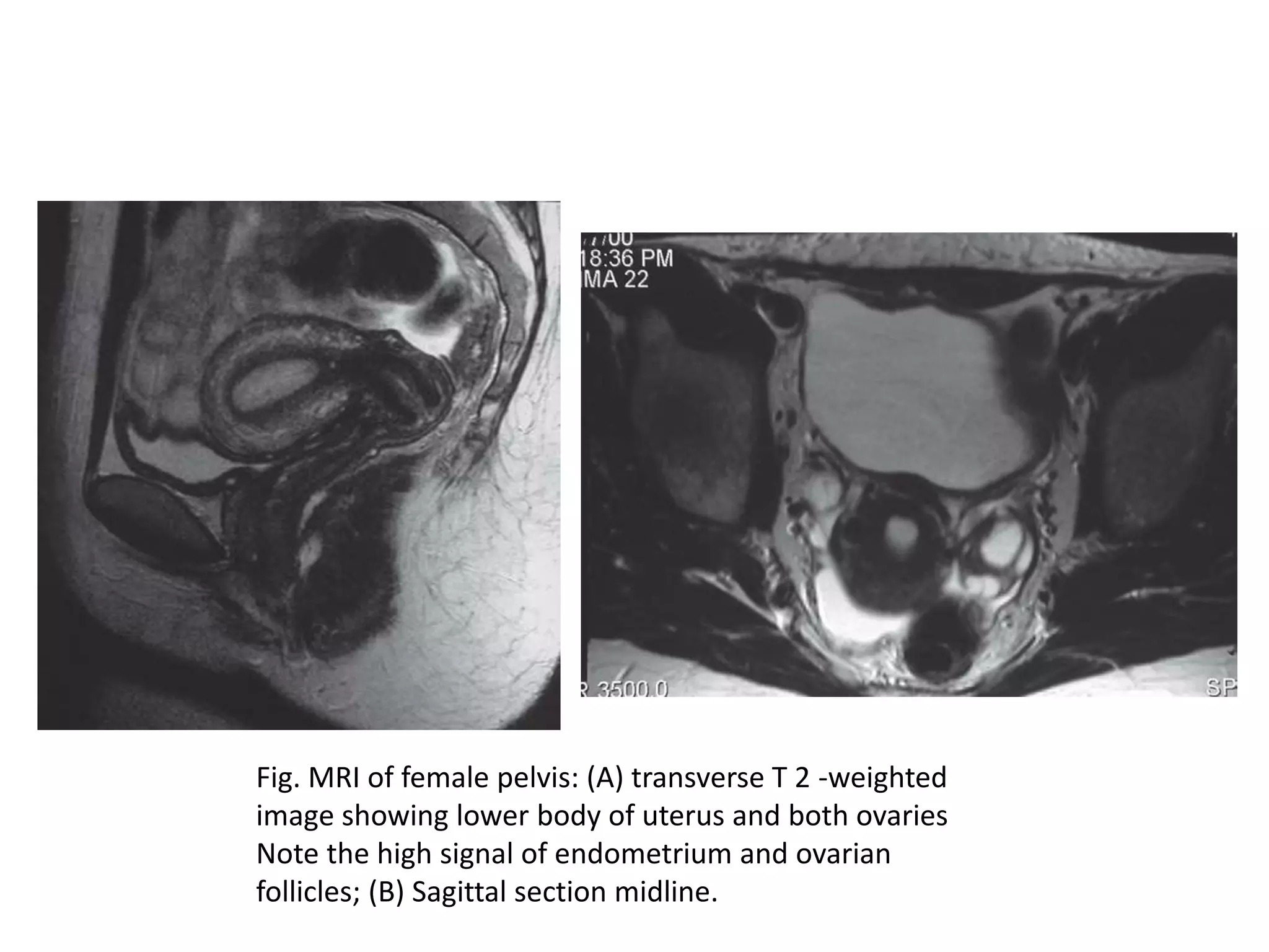 Malignant lesions of uterus | PPTX