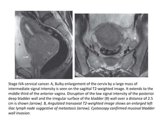 Malignant lesions of uterus | PPTX