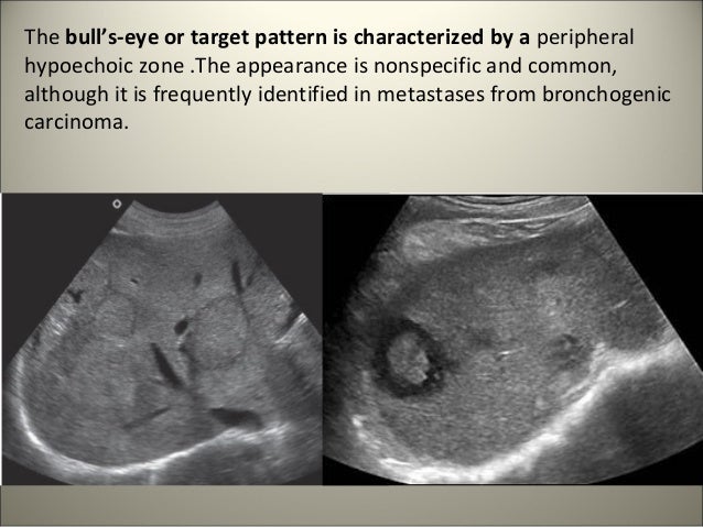 Focal malignant lesions of the liver.