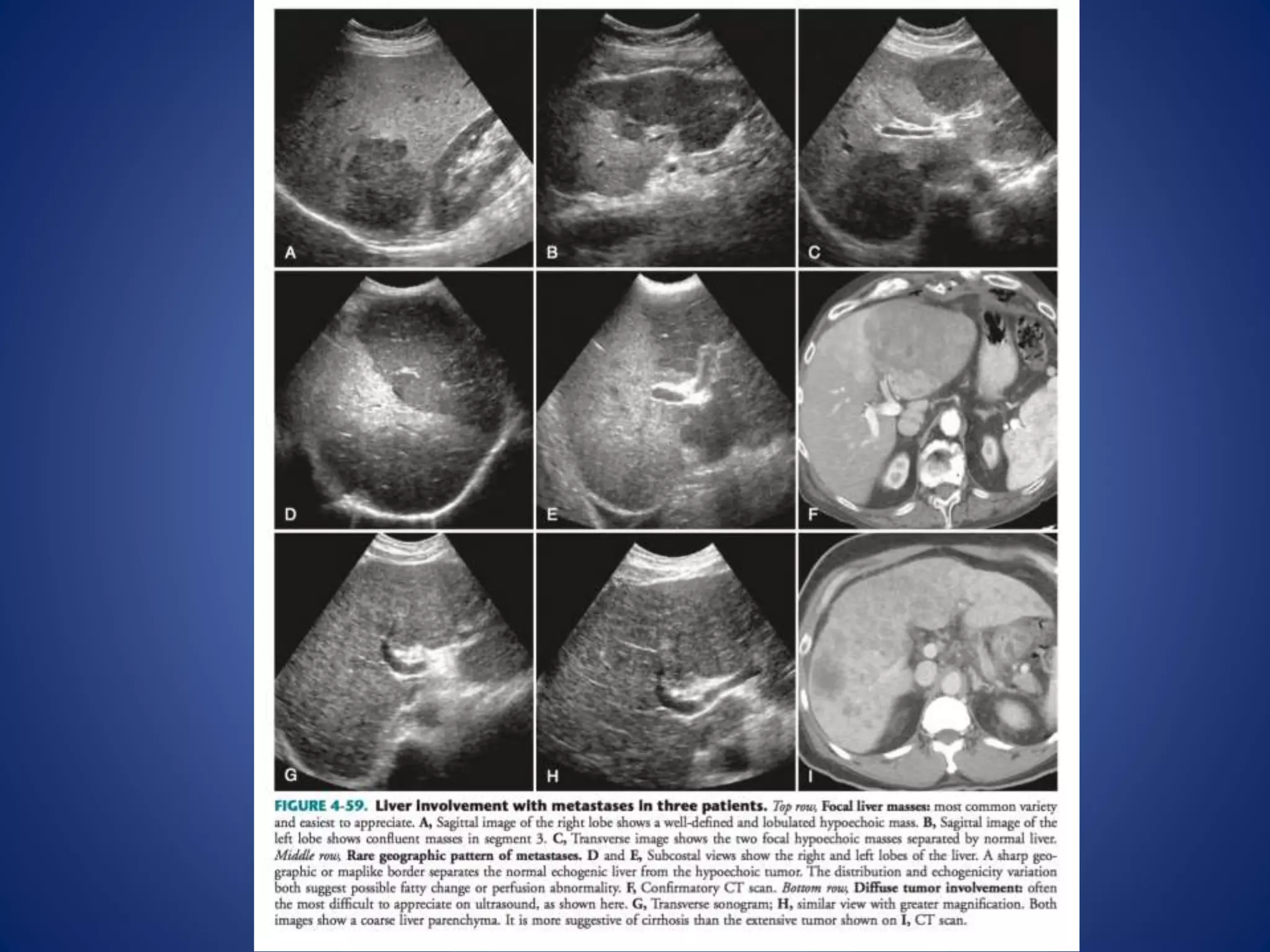 Malignant liver masses | PPT