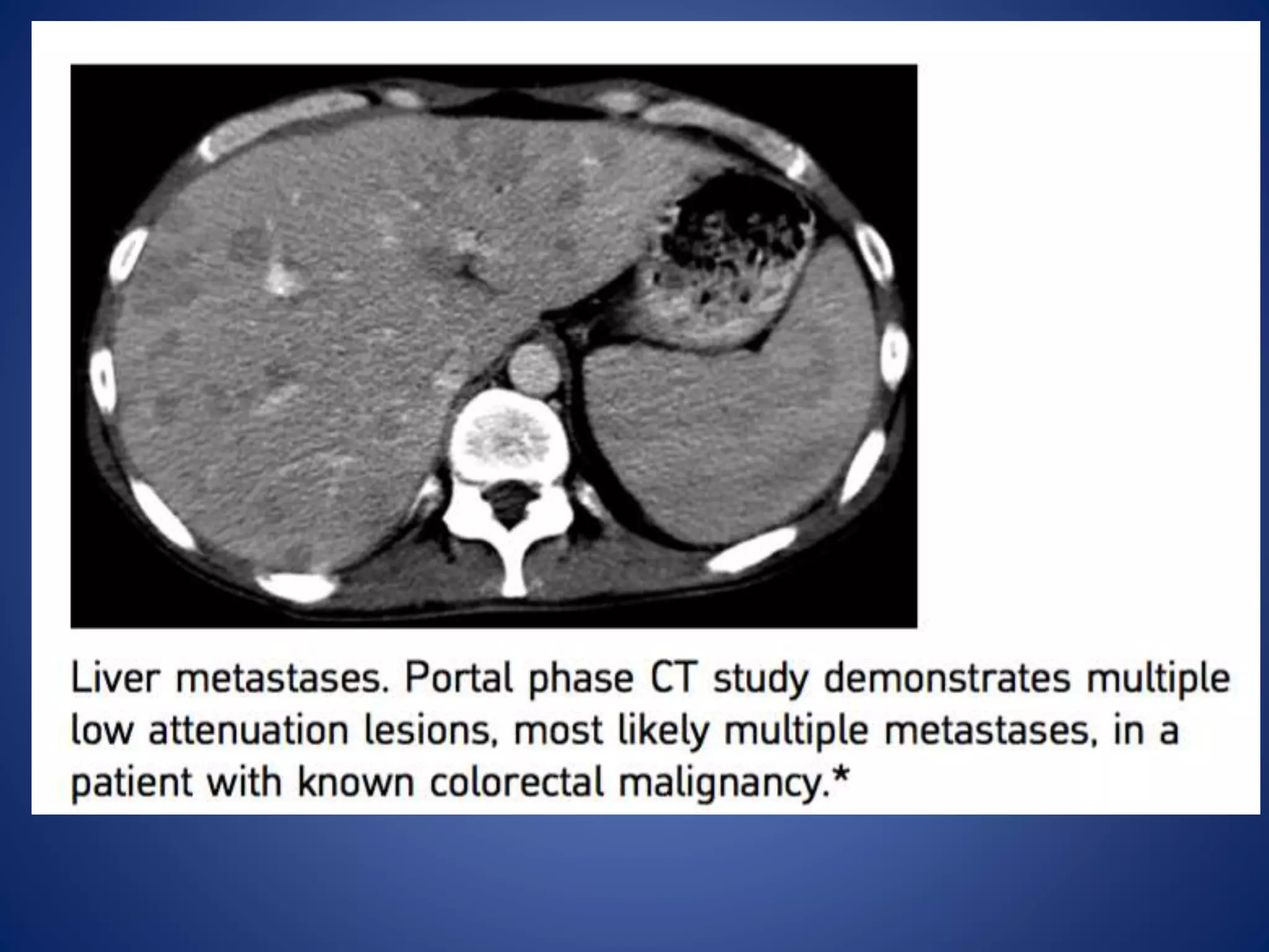 Malignant liver masses | PPT