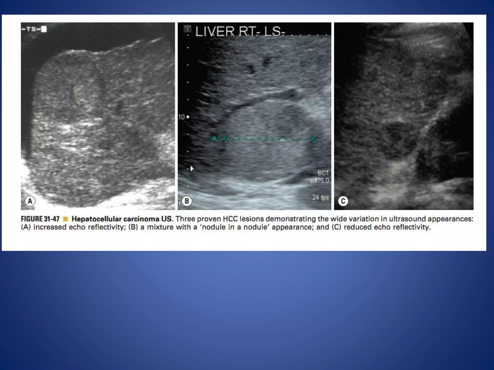 Malignant liver masses | PPT