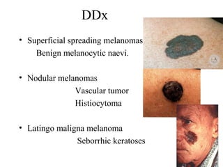 Malignant Melanoma | PPT