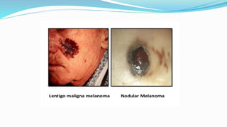Malignant melanoma A-Z | PPTX
