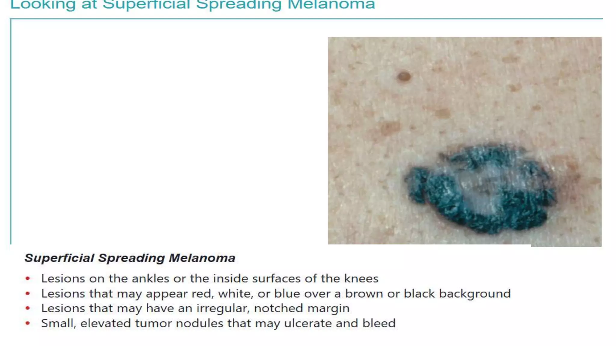 Malignant melanoma | PPTX | Cancer | Diseases and Conditions