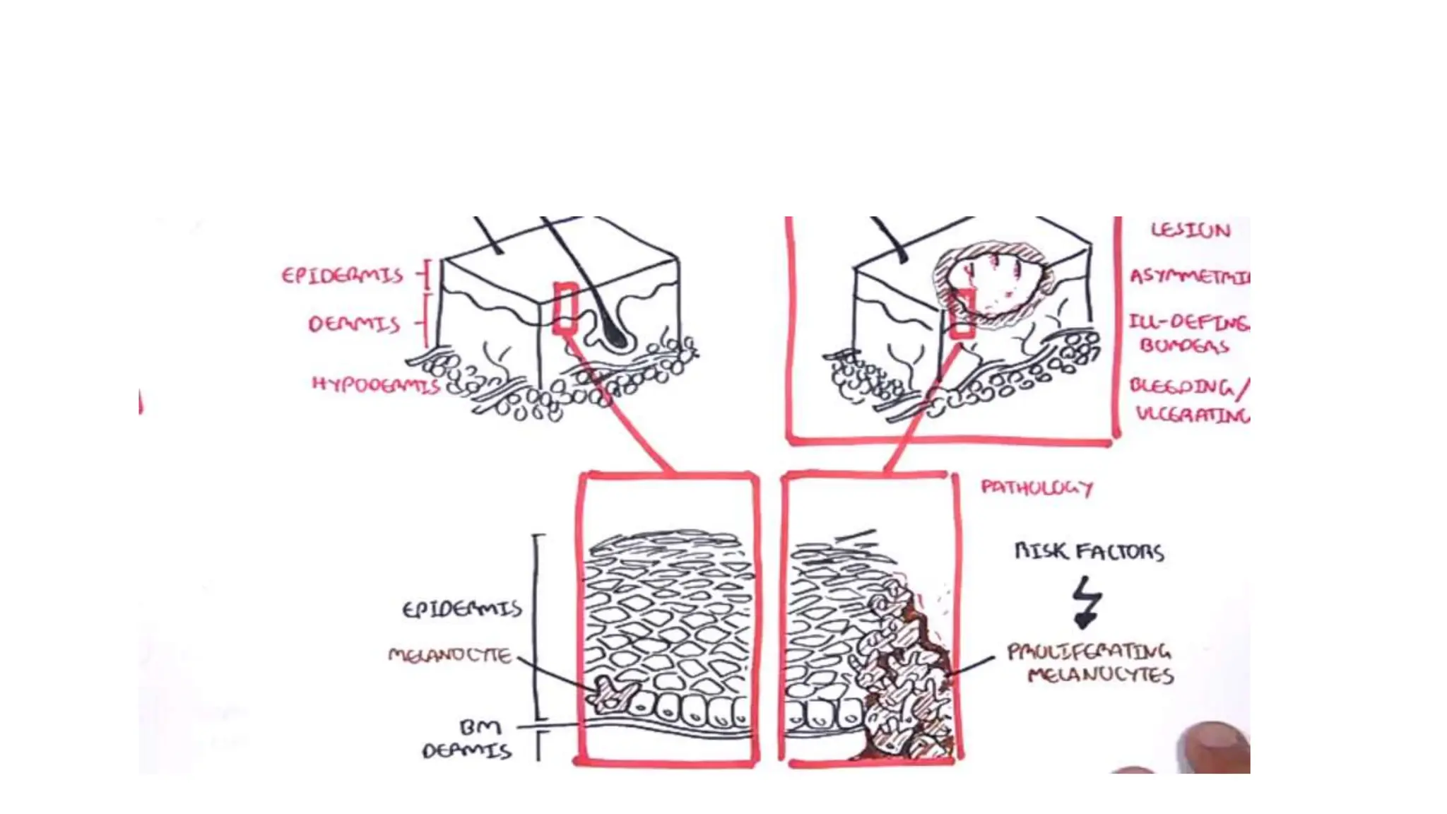 Malignant Melanoma.pptx