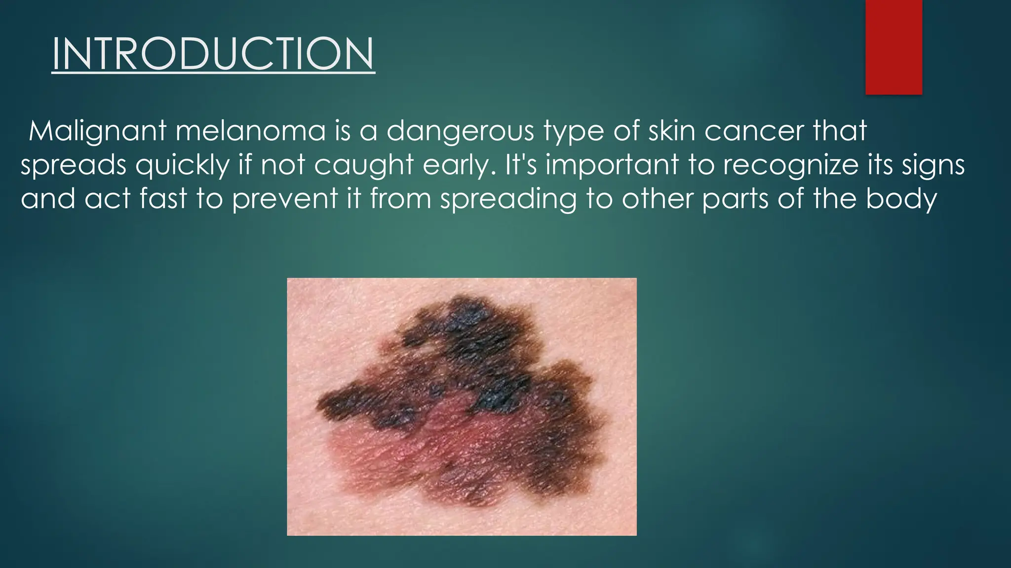 MALIGNANT MELANOMA (1).pptx . | PPTX