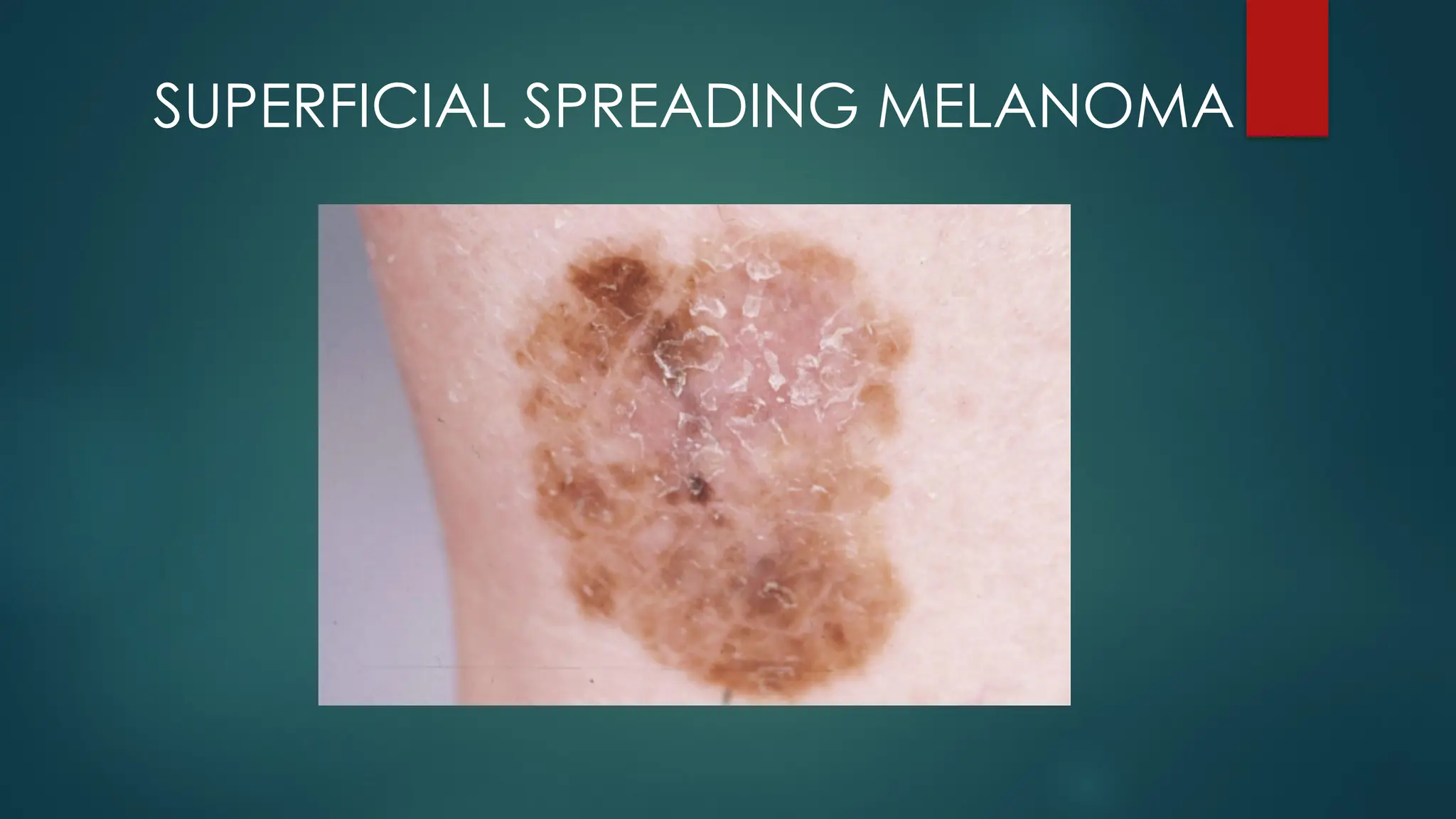 MALIGNANT MELANOMA (1).pptx . | PPTX