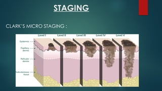 MALIGNANT MELANOMA (1).pptx . | PPTX