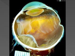 Malignant Melanoma of the eye .. (1).pptx