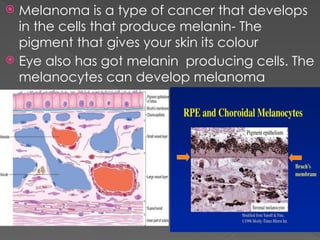 Malignant Melanoma of the eye .. (1).pptx