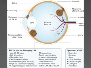 Malignant Melanoma of the eye .. (1).pptx