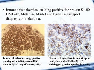 Malignant melanoma Dr chithra p | PPT