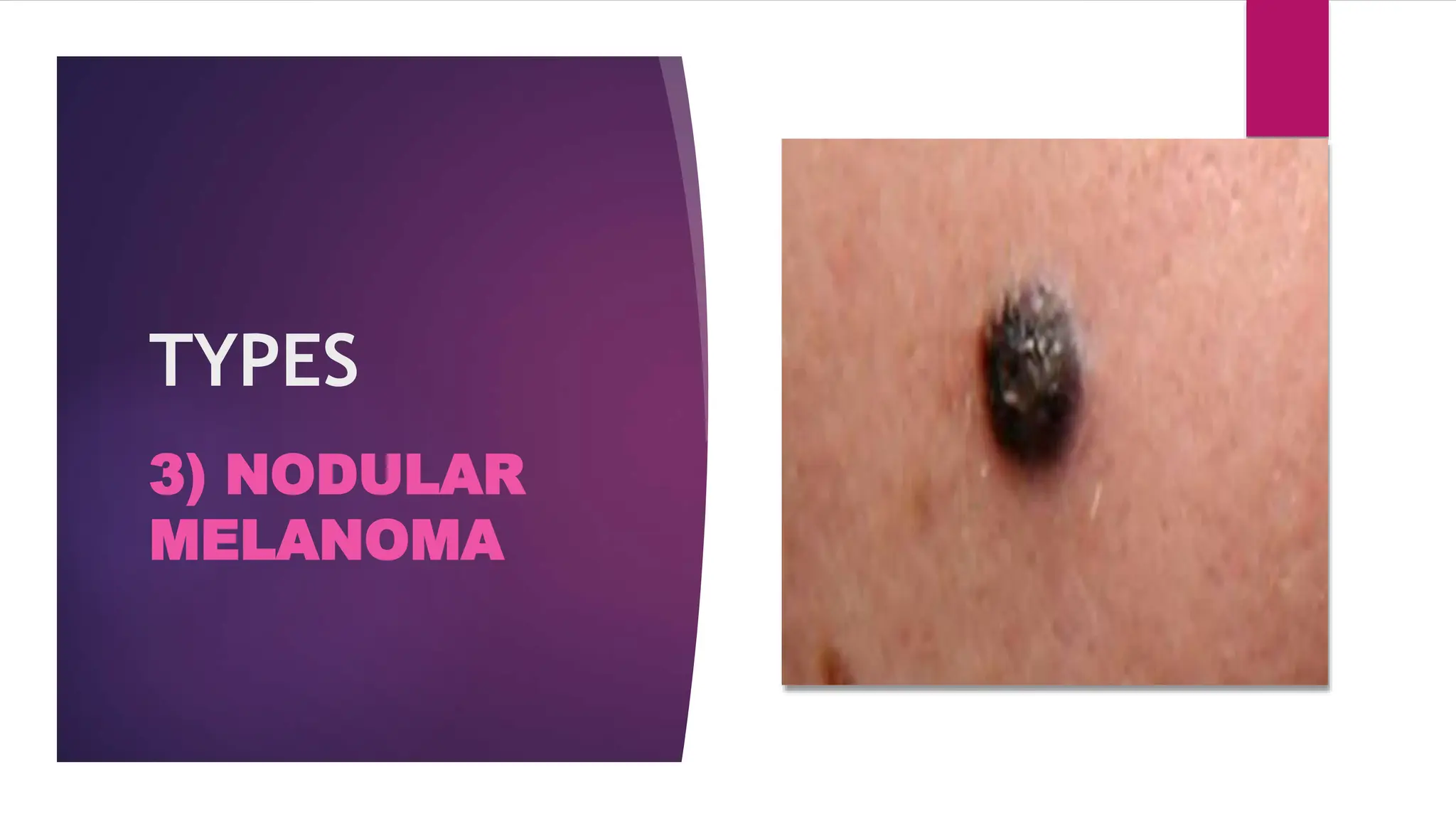 MALIGNANT MELANOMA skin cancer integumentary system | PPTX