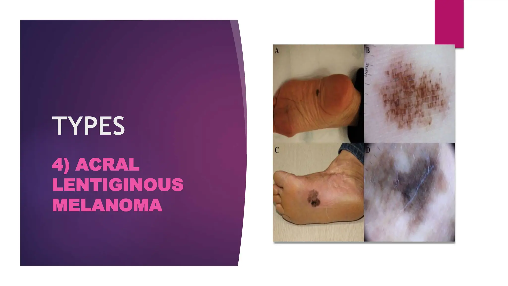 MALIGNANT MELANOMA skin cancer integumentary system | PPTX