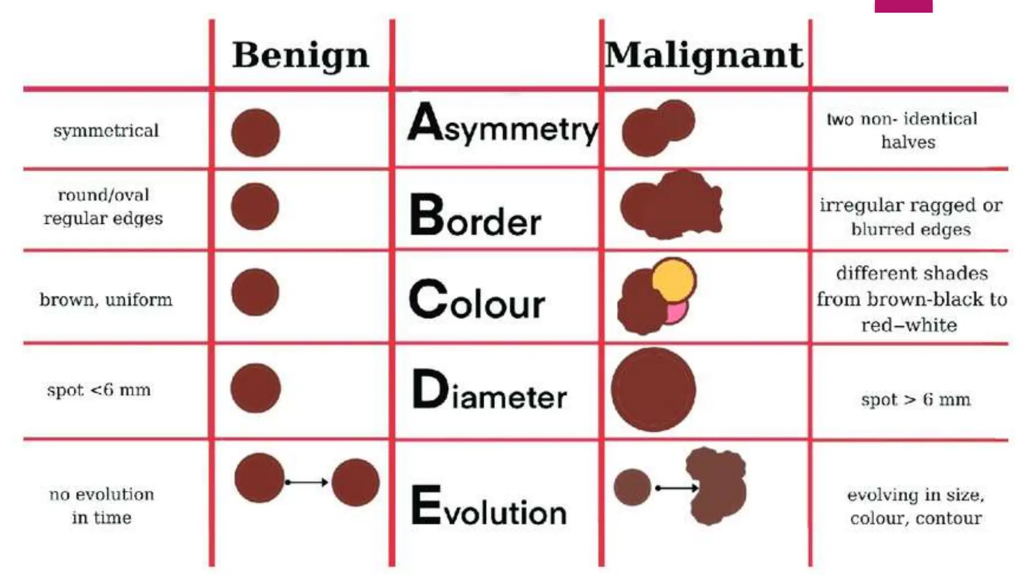 MALIGNANT MELANOMA skin cancer integumentary system | PPTX