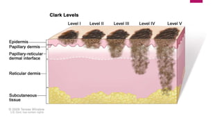 MALIGNANT MELANOMA skin cancer integumentary system | PPTX
