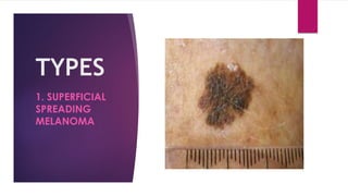 MALIGNANT MELANOMA skin cancer integumentary system | PPTX