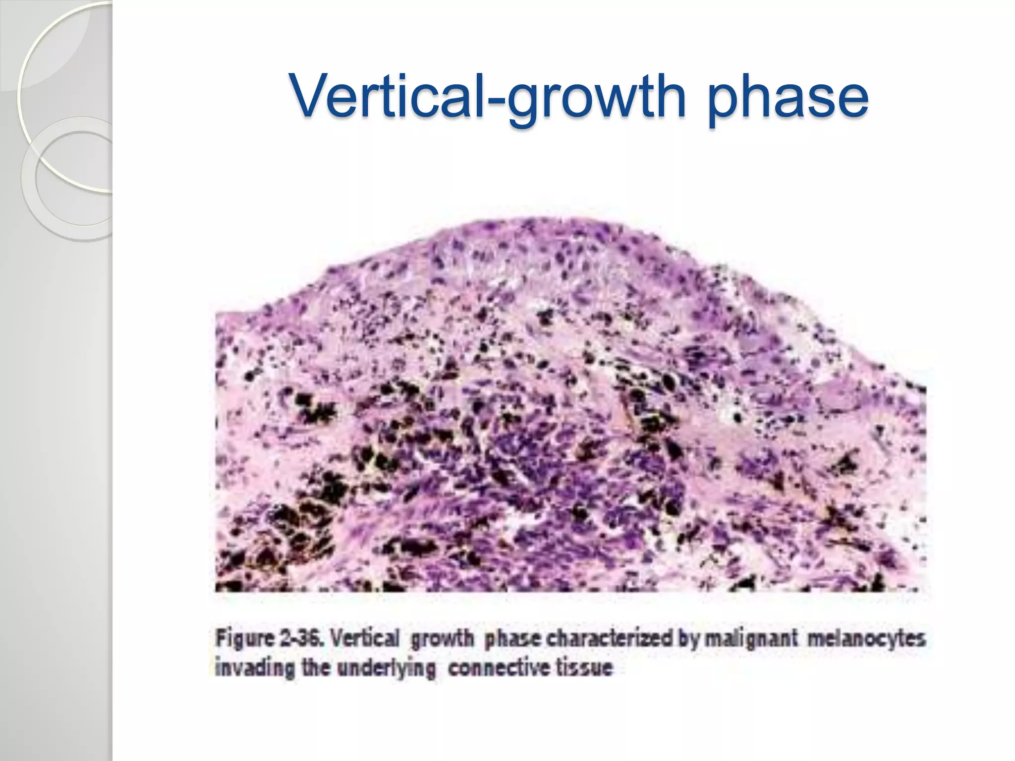 Malignant melanoma of the oral cavity | PPTX