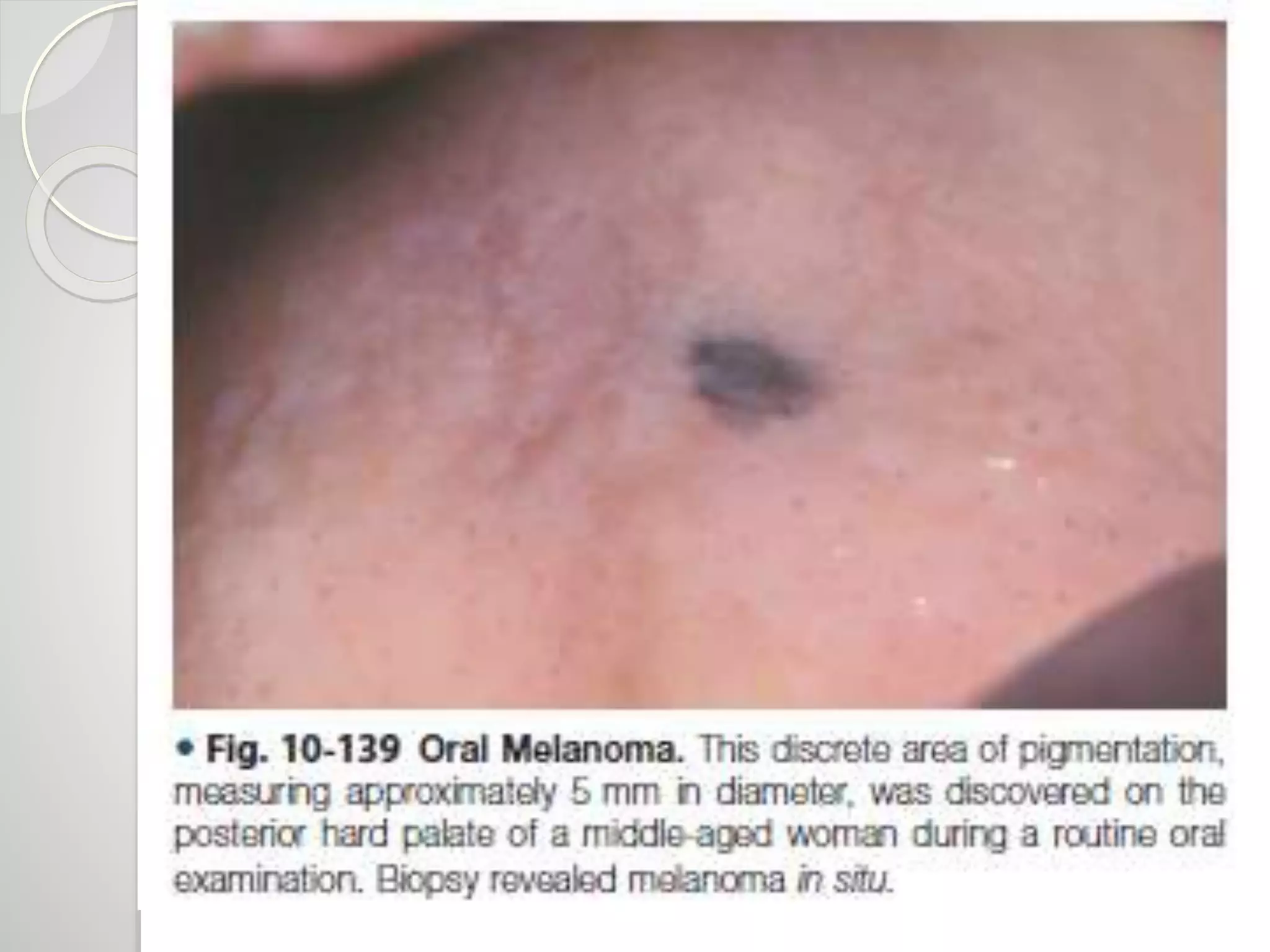 Malignant melanoma of the oral cavity | PPTX