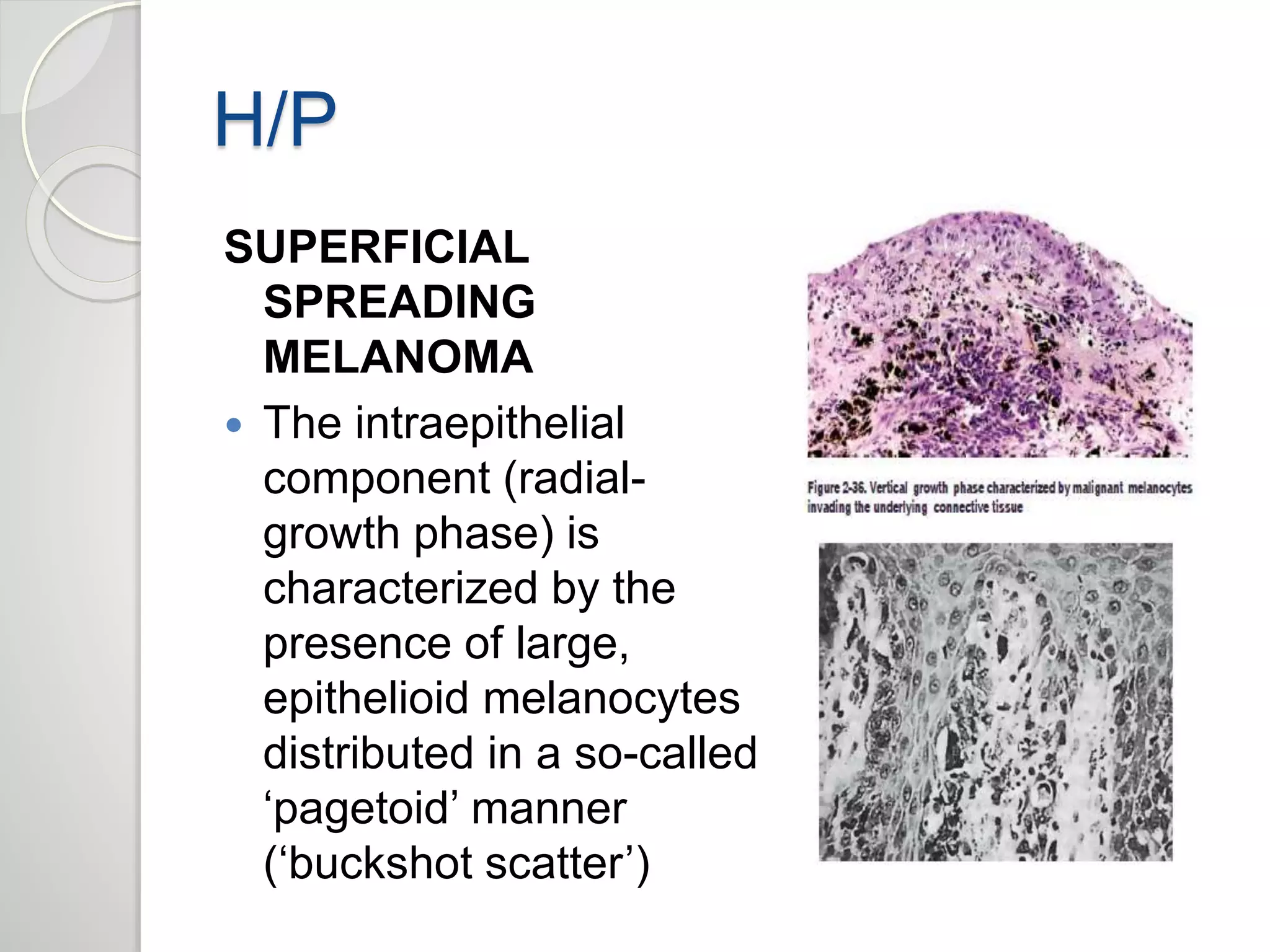 Malignant melanoma of the oral cavity | PPTX