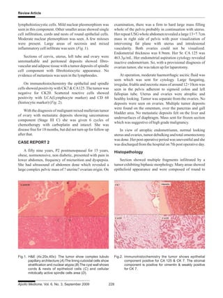 Malignant Mixed Mullerian Tumor – Case Reports and Review Article | PDF ...
