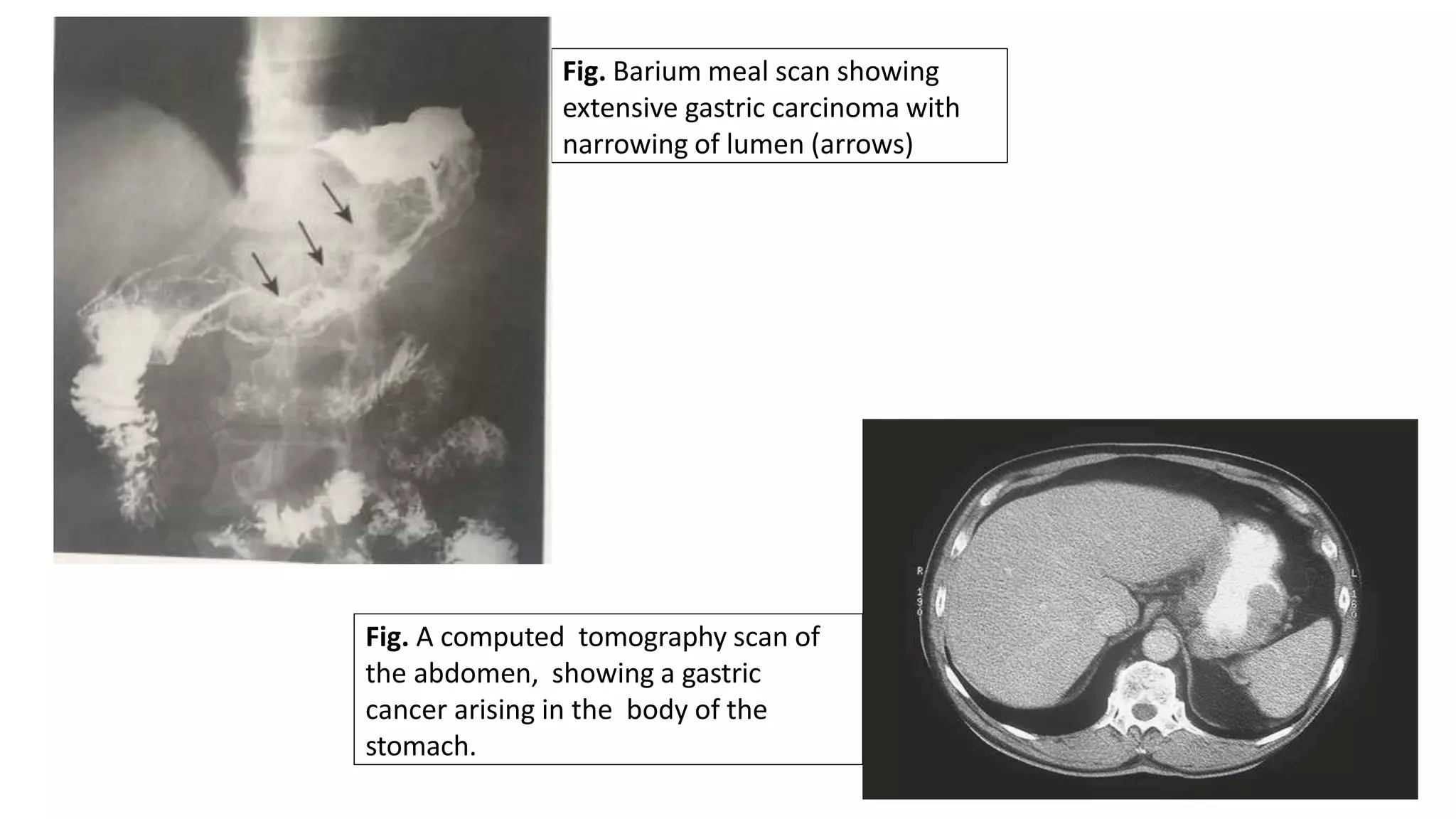 Malignant Neoplasms of Stomach.pptx