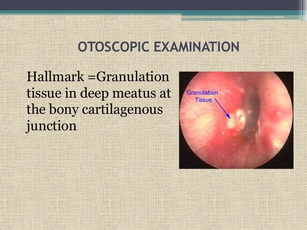 Malignant otitis externa