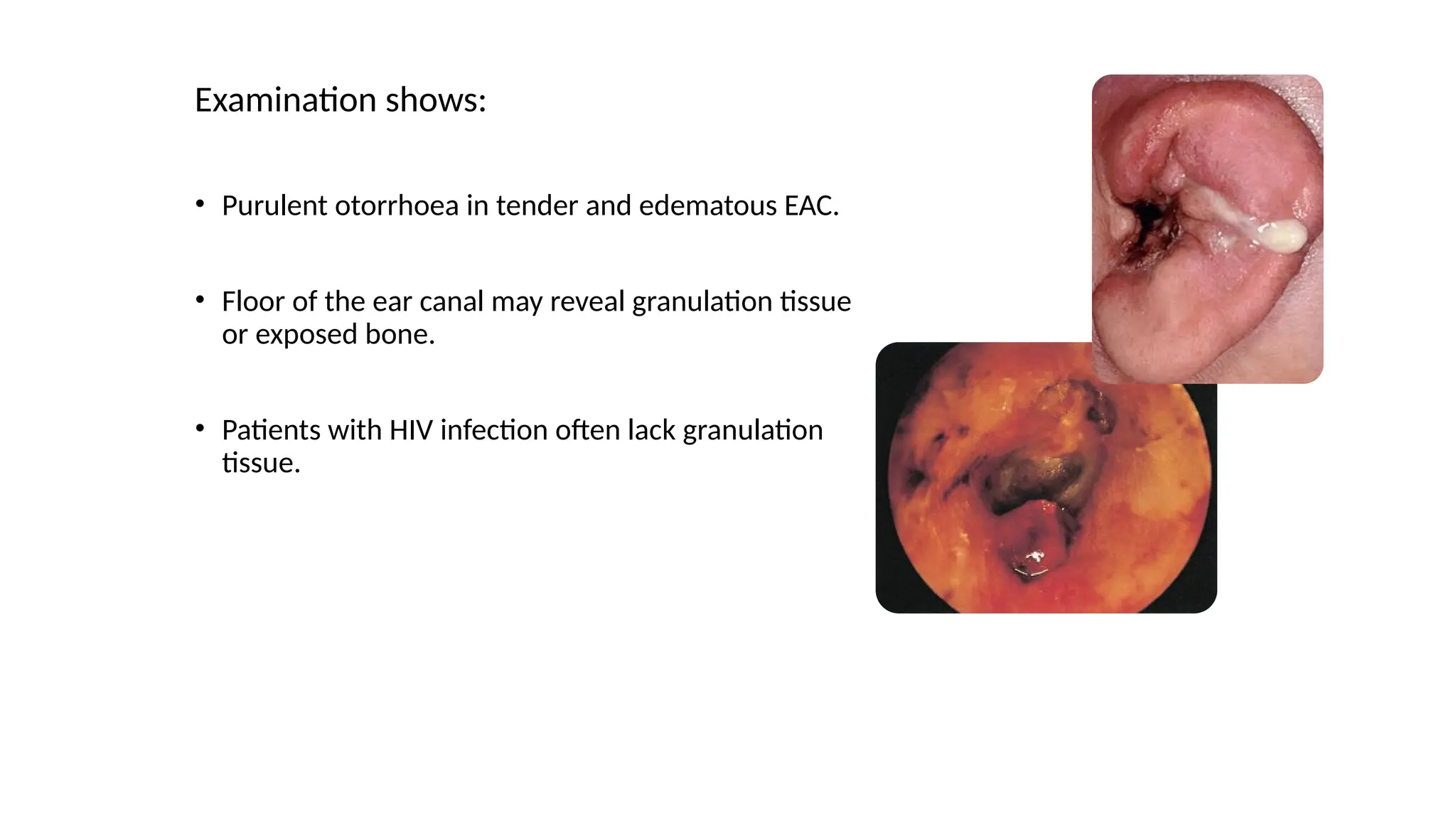 malignant otitis externa diseases of external ear | PPTX