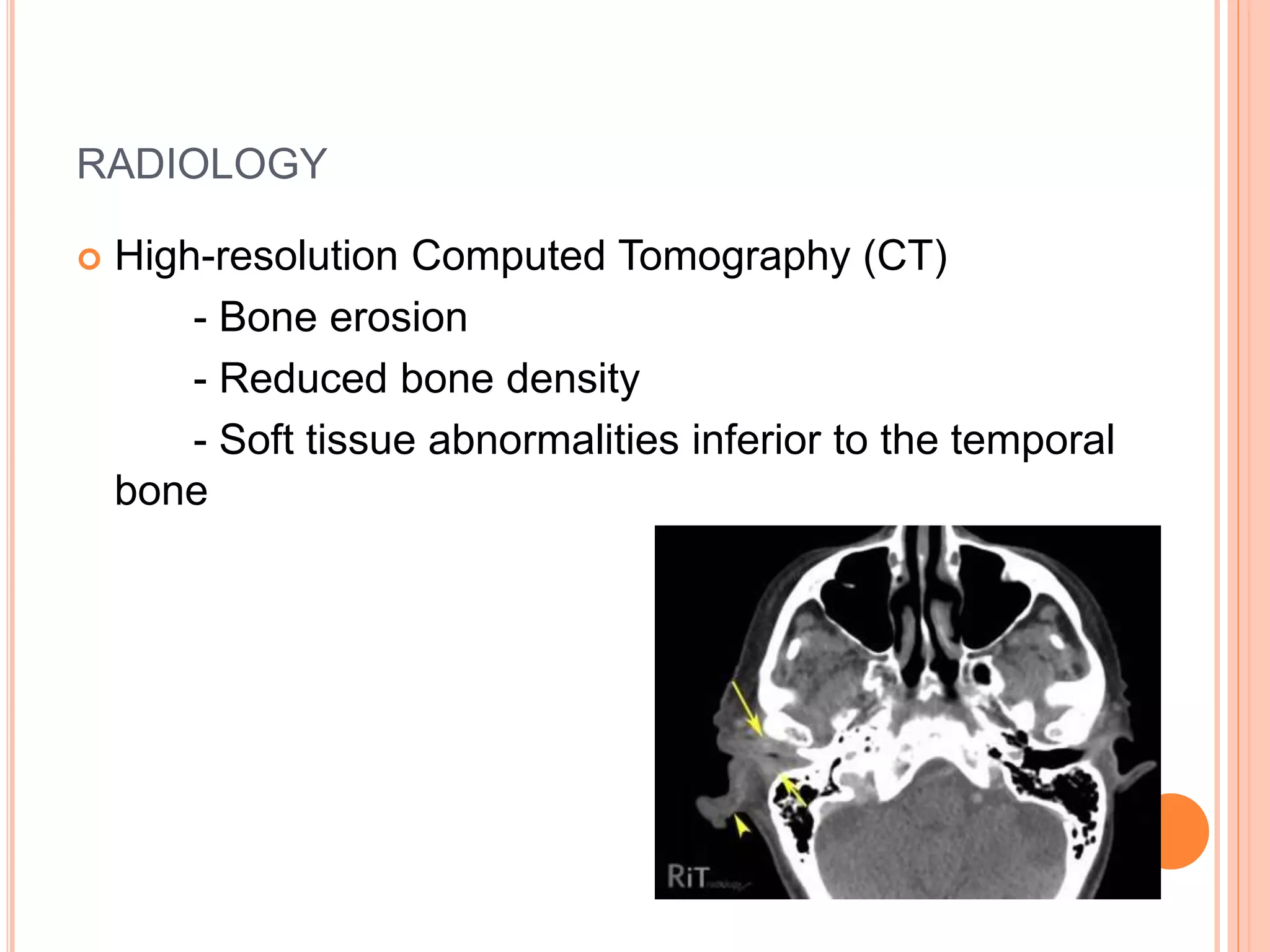 Malignant otitis externa clinical features and management | PPTX