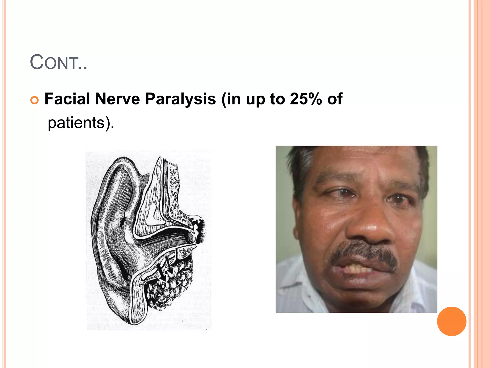 Malignant otitis externa clinical features and management | PPTX