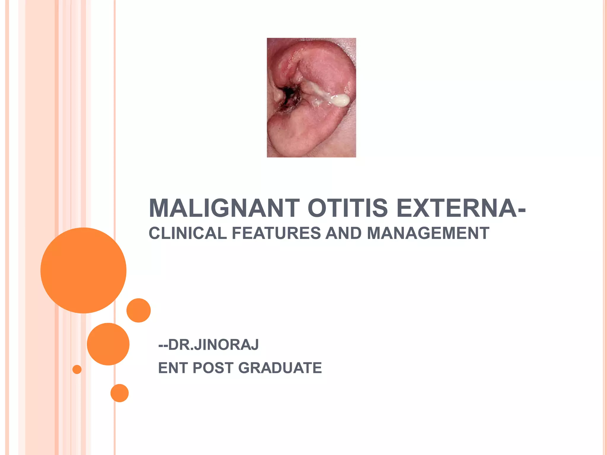 Malignant otitis externa clinical features and management | PPT