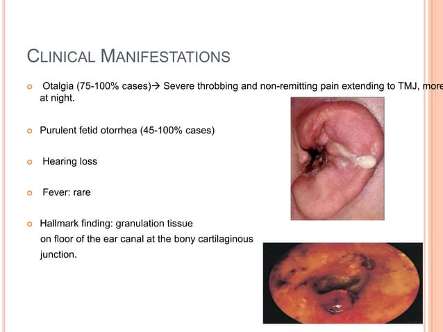 Malignant otitis externa clinical features and management | PPTX