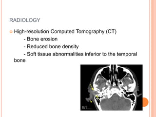 Malignant Otitis Externa Radiology