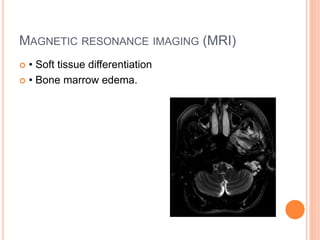 Malignant Otitis Externa Mri