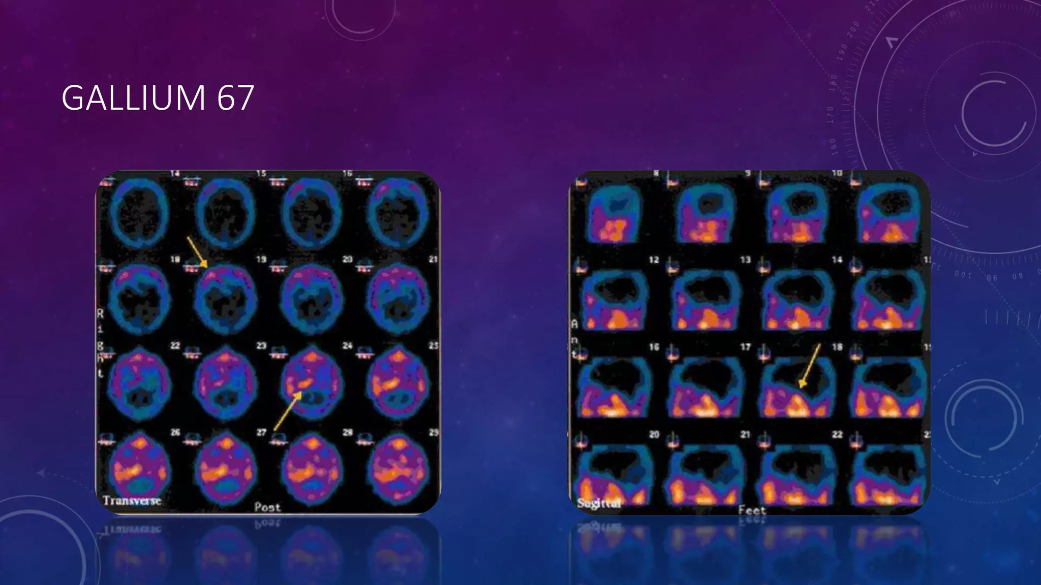 Malignant Otitis Externa by Dr.S .pptx