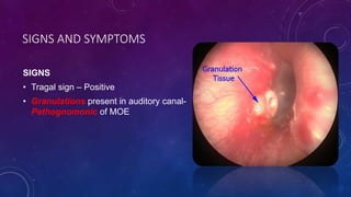 Malignant Otitis Externa by Dr.S .pptx