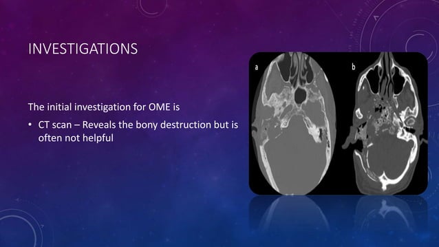 Malignant Otitis Externa by Dr.S .pptx