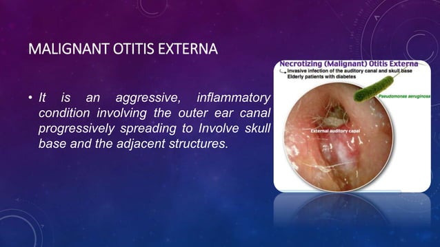 Malignant Otitis Externa by Dr.S .pptx