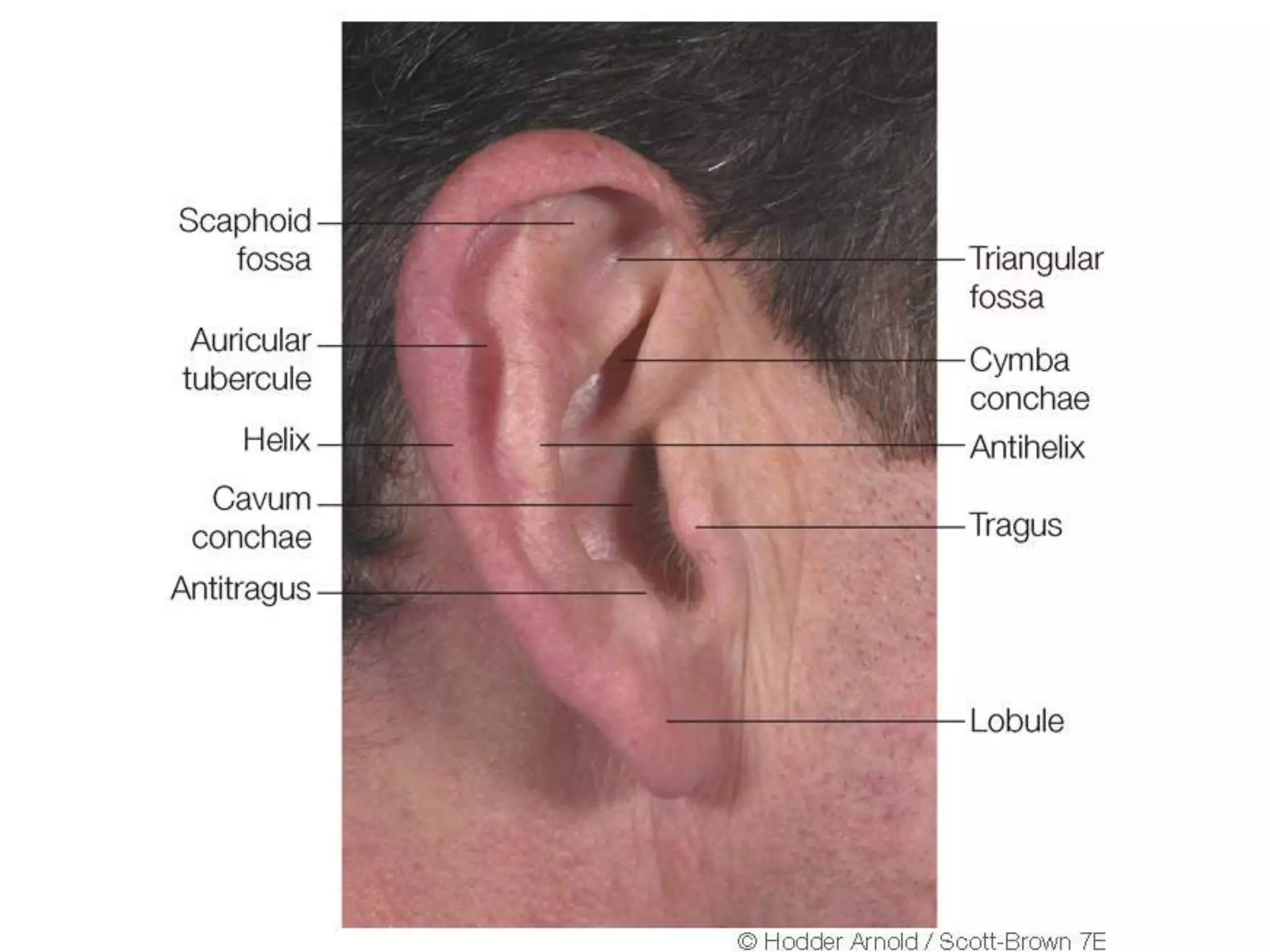 Malignant otitis externa | PPTX