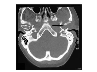 Malignant Otitis Externa Radiology