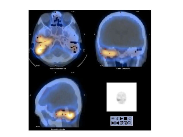 Malignant otitis externa