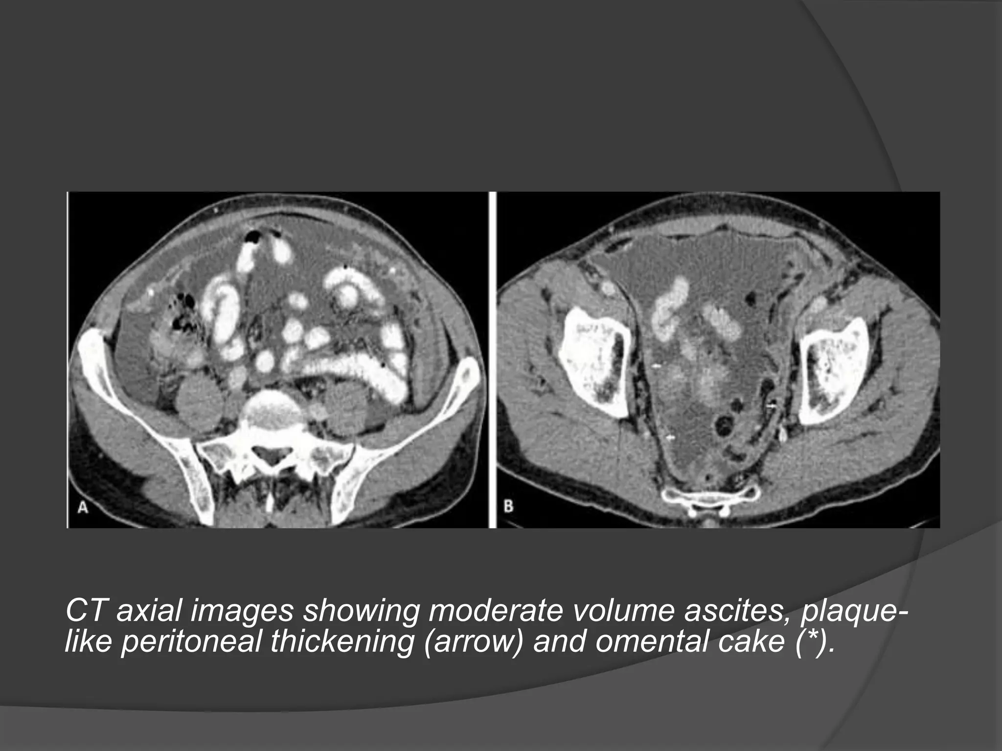 Malignant Peritoneal Mesothelioma | PPTX