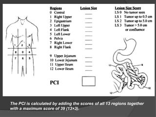 Malignant Peritoneal Mesothelioma | PPTX