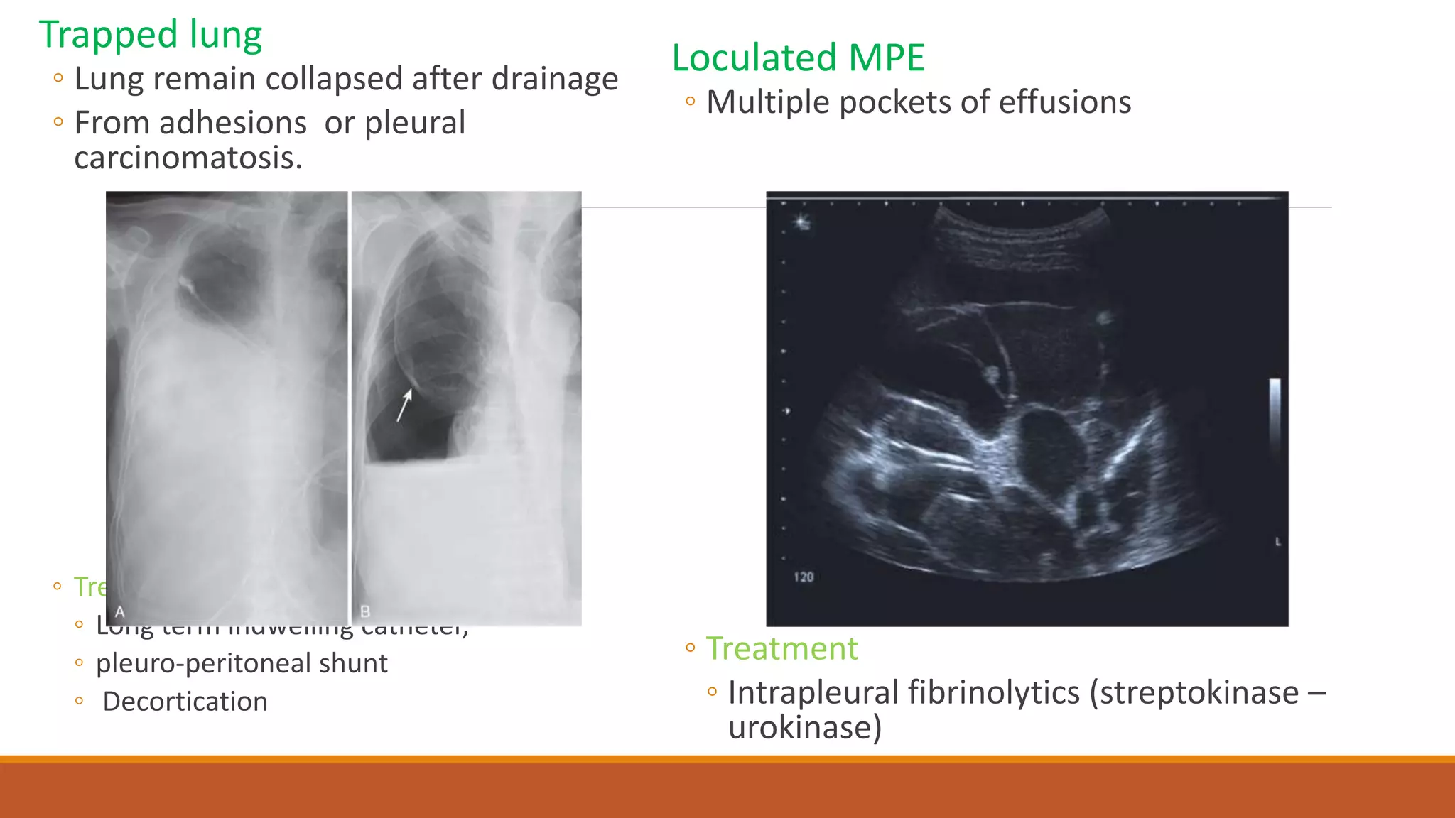 Malignant pleural effusion | PPTX