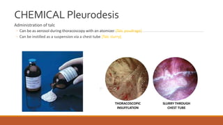 Malignant pleural effusion | PPTX