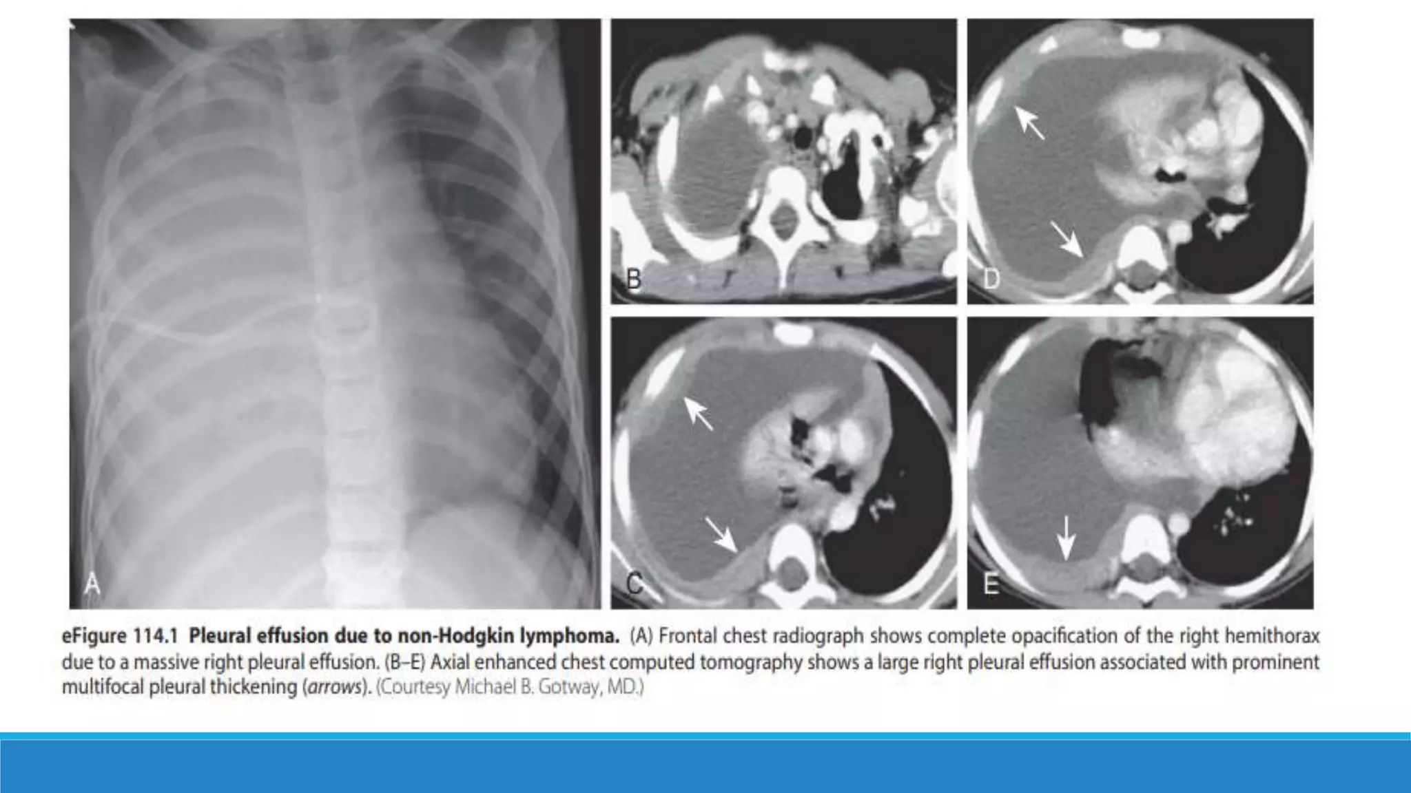 MALIGNANT PLEURAL EFFUSION..pptx